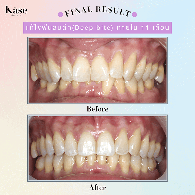 Kase Aligner จัดฟันแบบใส ราคา 49,000.- | THE IVORY DENTAL