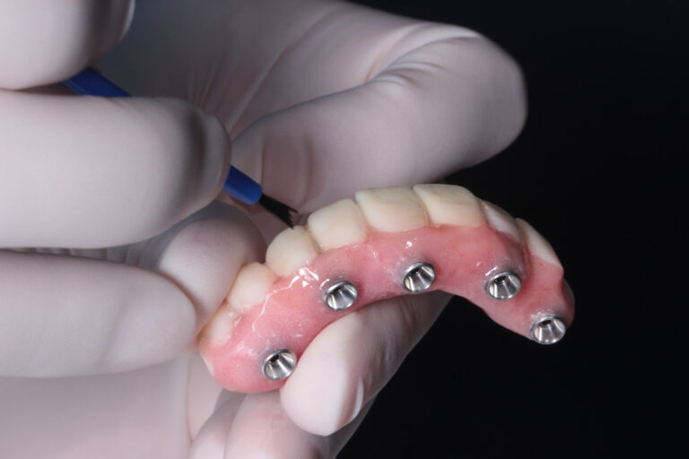 proper-dental-implant-removal-aftercare